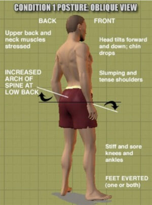 3 Posture Conditions That Can Cause Us Pain