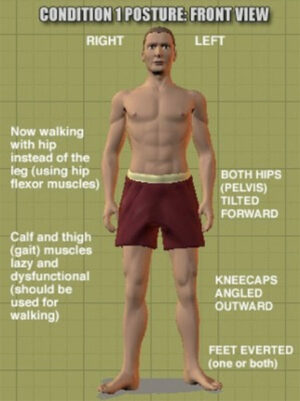 3 Posture Conditions That Can Cause Us Pain